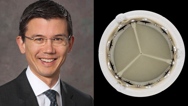 Cardiology Innovations: Transcatheter Mitral Valve Re-Operations