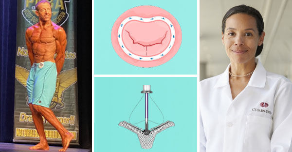 Doctor Q&A: Mitral Valve Surgery & PRIMARY Clinical Trial