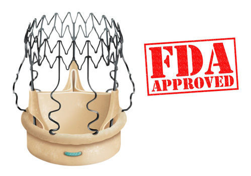 Technology Update: Perceval Sutureless Valve Gets FDA Approval