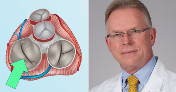 Surgeon Q&A: Mitral Valve Surgery Insights for Patients