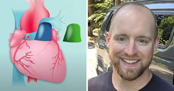 Ross Procedure - Adam’s Heart Valve Surgery Blog