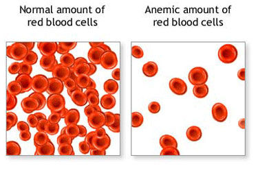 Anemia After Heart Surgery: Facts for Patients & Caregivers