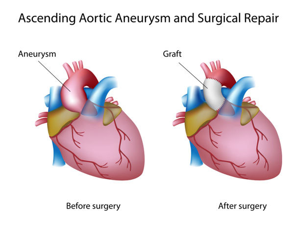 Bicuspid Aortic Valve Aneurysm Guidelines