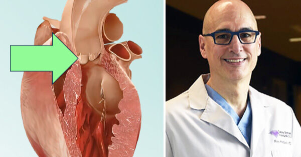 Surgeon Q&A: Aortic Root Carving, Enlargement & Replacement