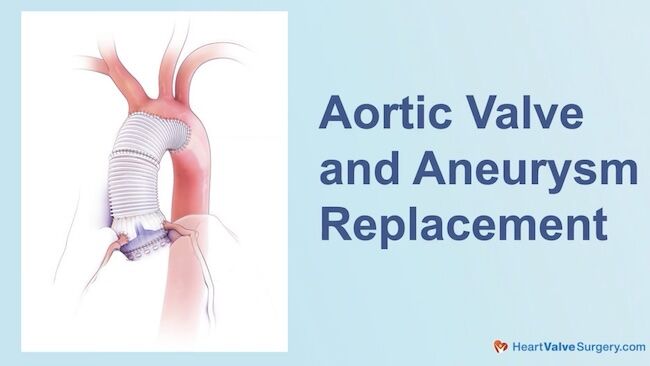 Aneurysms, Bicuspid Valves & Connective Tissue Disorders