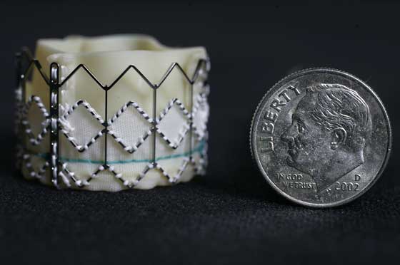 Heart Valve Size & Diameter