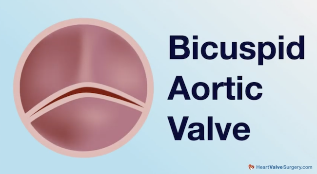 Surgeon Roundtable: Aortic Valve & Aneurysm Treatment