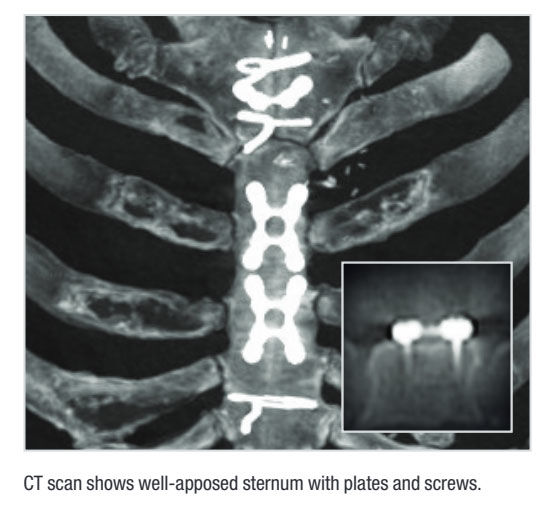 Rigid Sternal Fixation: Top 6 Facts for Patients