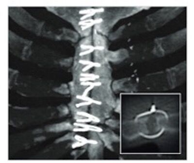 Rigid Sternal Fixation: A New Approach to Sternal Closure