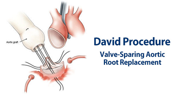 David Procedure For Aortic Root Replacement Valve Sparing