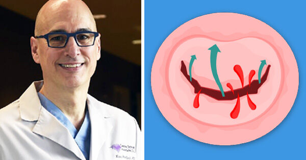 Surgeon Insights: The Different "Faces" of Mitral Valve Disease