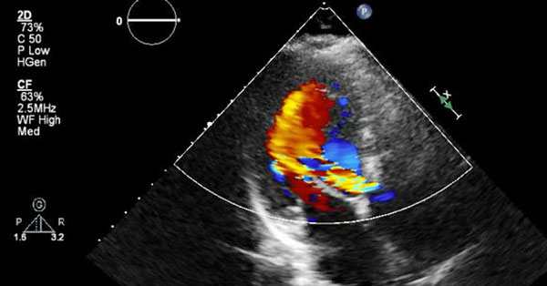 Bicuspid Aortic Valve Types Echo