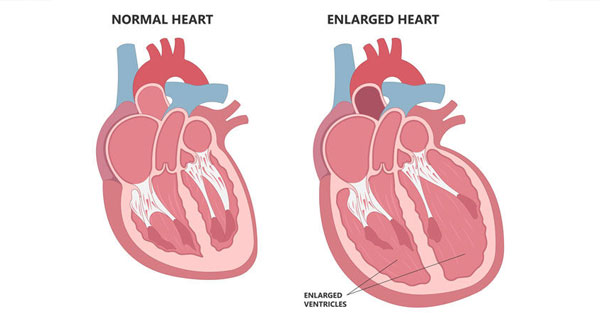 Enlarged Heart: What Should Patients Know?