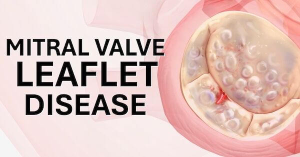 Thickened Mitral Valve Leaflets: What Should Patients Know?