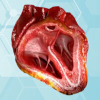Learning Center for Heart Valve Disease & Surgery