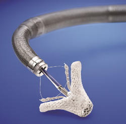 Ask the Expert: Is the MitraClip a Standard Procedure