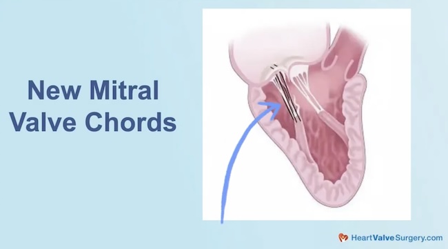 Mitral Valve Resection Techniques: What Should Patients Know?