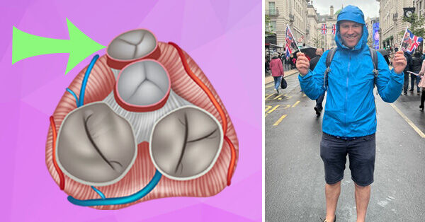 Surgeon Q&A: The Ross Procedure & Leaky Pulmonary Valves?