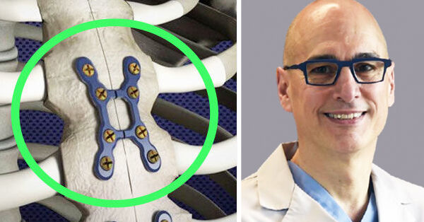 Rigid Sternal Fixation: A New Approach to Sternal Closure