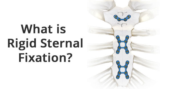 Rigid Sternal Fixation Top 6 Facts For Patients