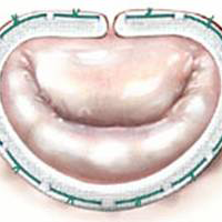 Surgeon Q&A: Heart Valve Repair Ring Durability