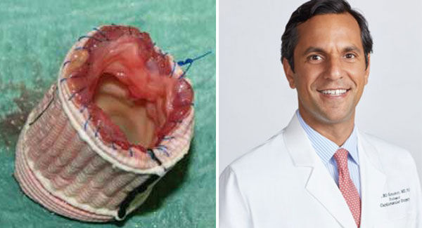 Surgeon Q&A: Ross Procedure Autograft Wrapping with Dr. El-Hamamsy