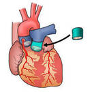 Heart Valve Surgery Resources for Patients & Caregivers