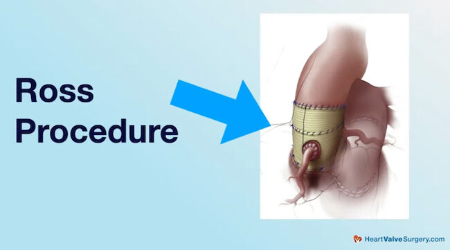 Surgeon Q&A: Inspecting the Pulmonary Valve During Ross Procedure