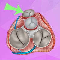Learning Center for Heart Valve Disease & Surgery
