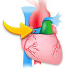 Heart Valve Surgery Resources for Patients & Caregivers