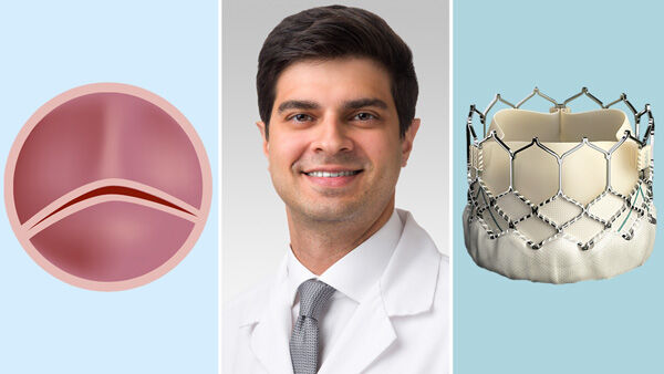 Bicuspid Aortic Valve: SAVR or TAVR? Bicuspid Aortic Valve: SAVR or TAVR?