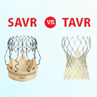 Learning Center for Heart Valve Disease & Surgery