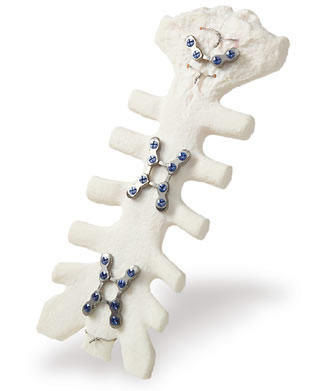 Chest Pain After Heart Surgery From Sternum Wires