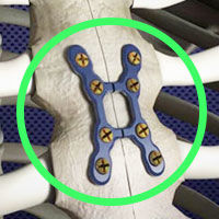 SternaLock Blu: Fast Healing & Less Pain for Heart Surgery