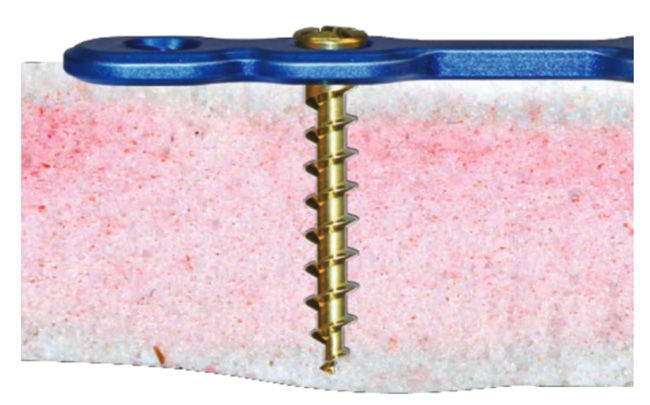 SternaLock Blu: Fast Healing & Less Pain for Heart Surgery