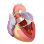 Heart & Sternum Healing After Surgery: Patient Discussion