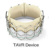 Surgeon Q&A: Transfemoral & Transapical TAVR Implant Approaches