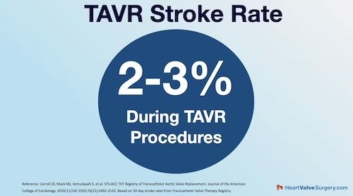 Doctor Q&A: Stroke Risk and Prevention During TAVR