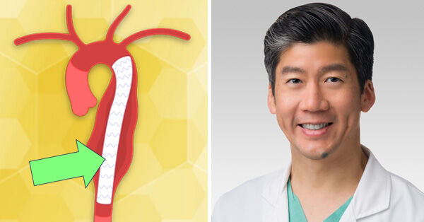 Surgeon Q&A: Can Aortic Aneurysms Be Repaired Using A Catheter?