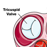 Quadricuspid Aortic Heart Valves -- Patient Information